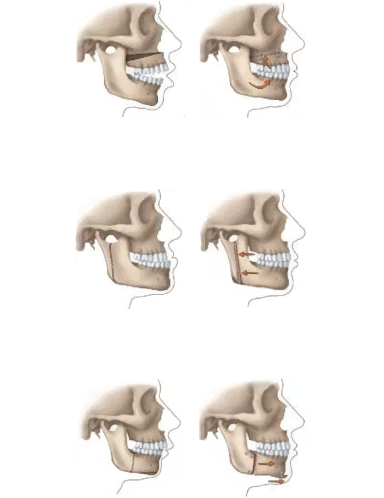 Jaw Surgery Knoxville Tn Corrective Jaw Surgery