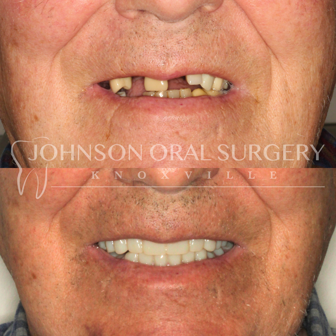 Oral Surgeon Knoxville TN | Oral Surgery